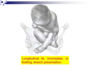 mechanism-of-labour.ppt OBSTETRICS and gynaecologist | PPT