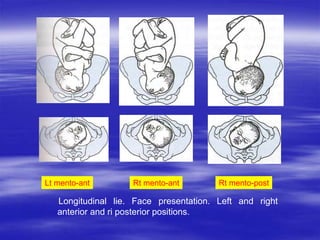 mechanism-of-labour-normal-and-abnormal.ppt