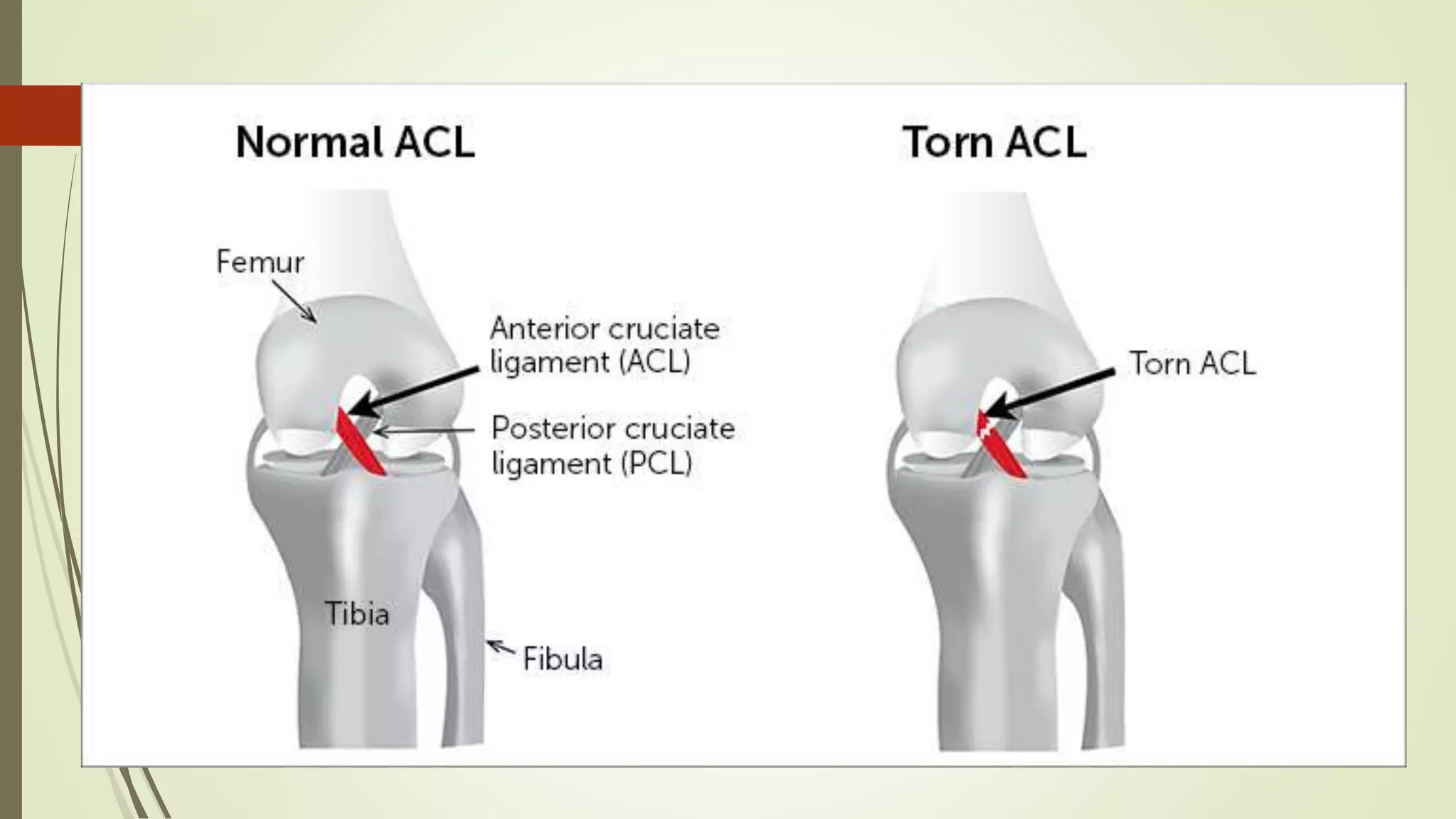 Mechanism of ACL InjURY | PPTX