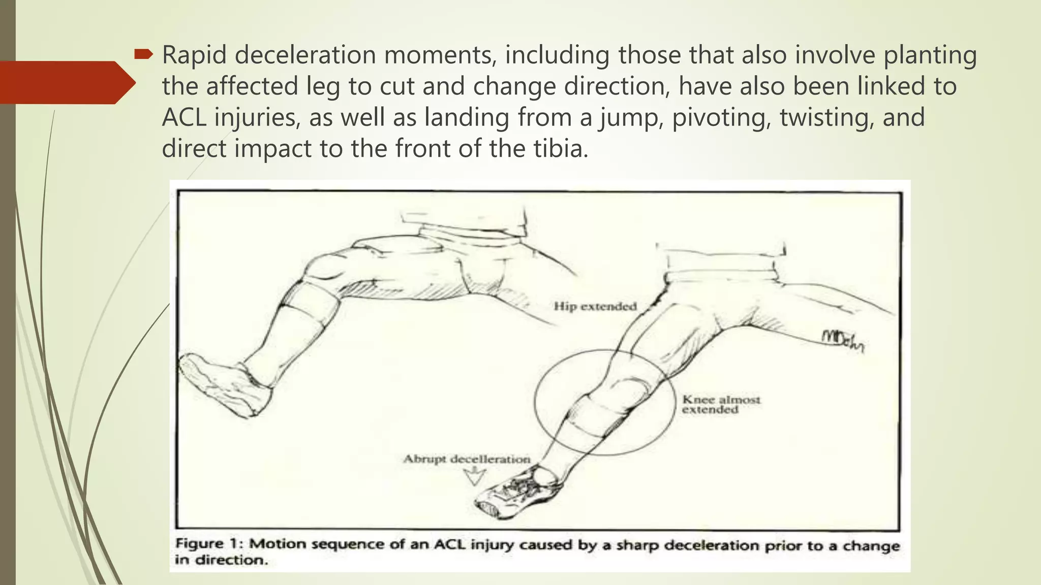 Mechanism of ACL InjURY | PPTX