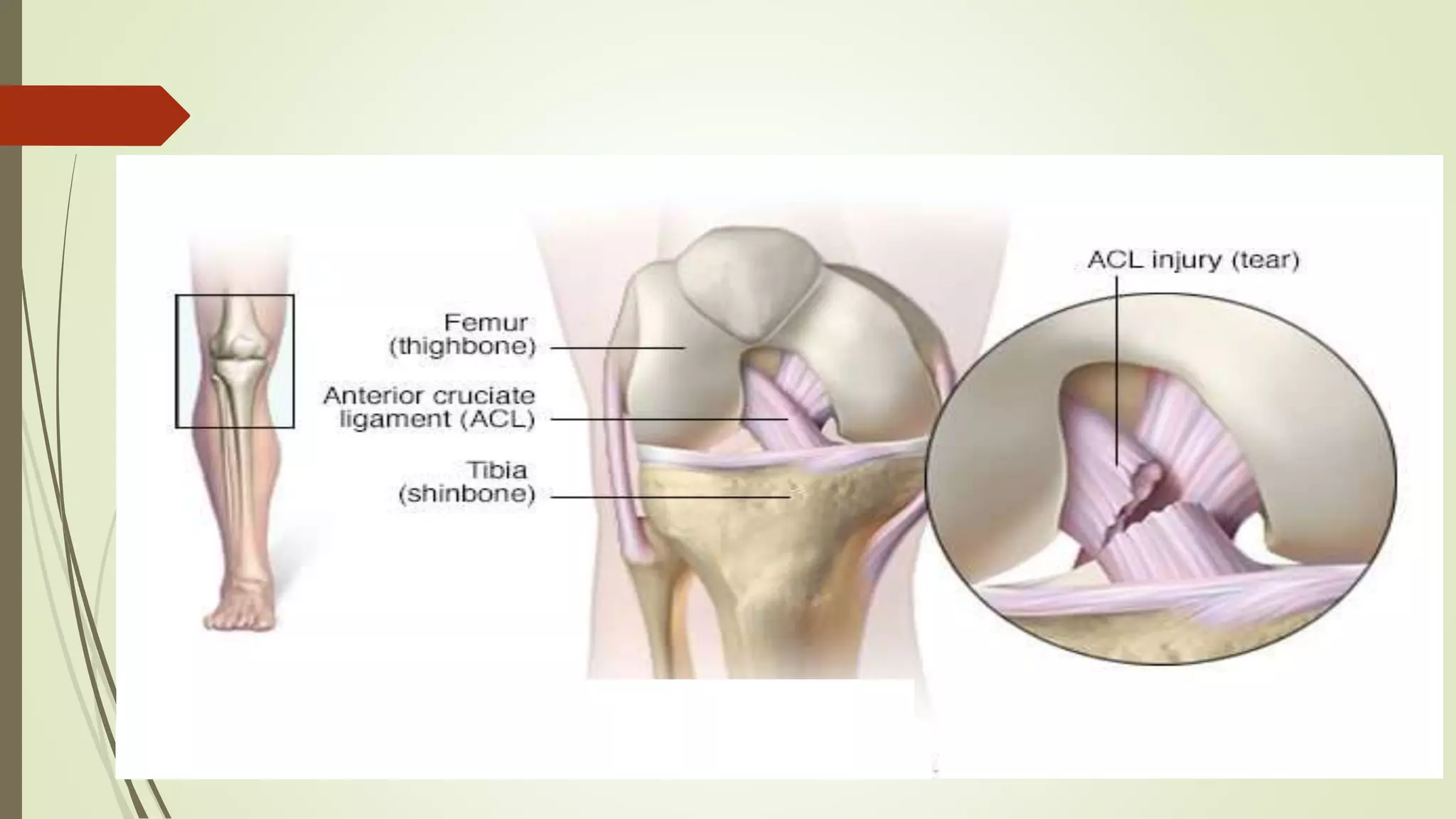 Mechanism of ACL InjURY | PPTX
