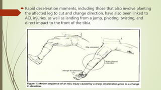 Mechanism of ACL InjURY | PPTX