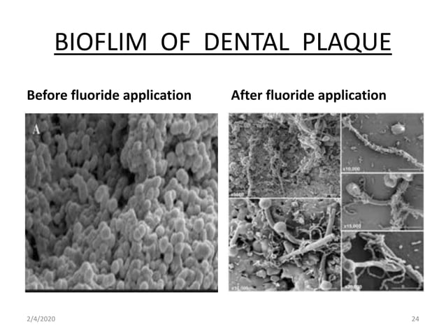 Mechanism of action of fluorides | PPTX