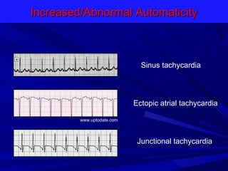 Mechanism of arrythmias | PPT