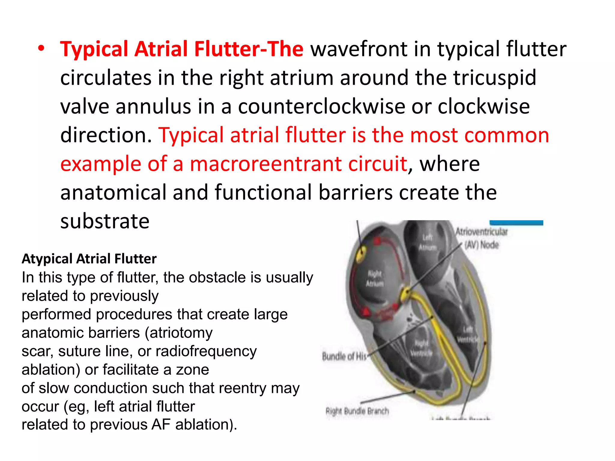 Mechanism of arrythmias | PPTX