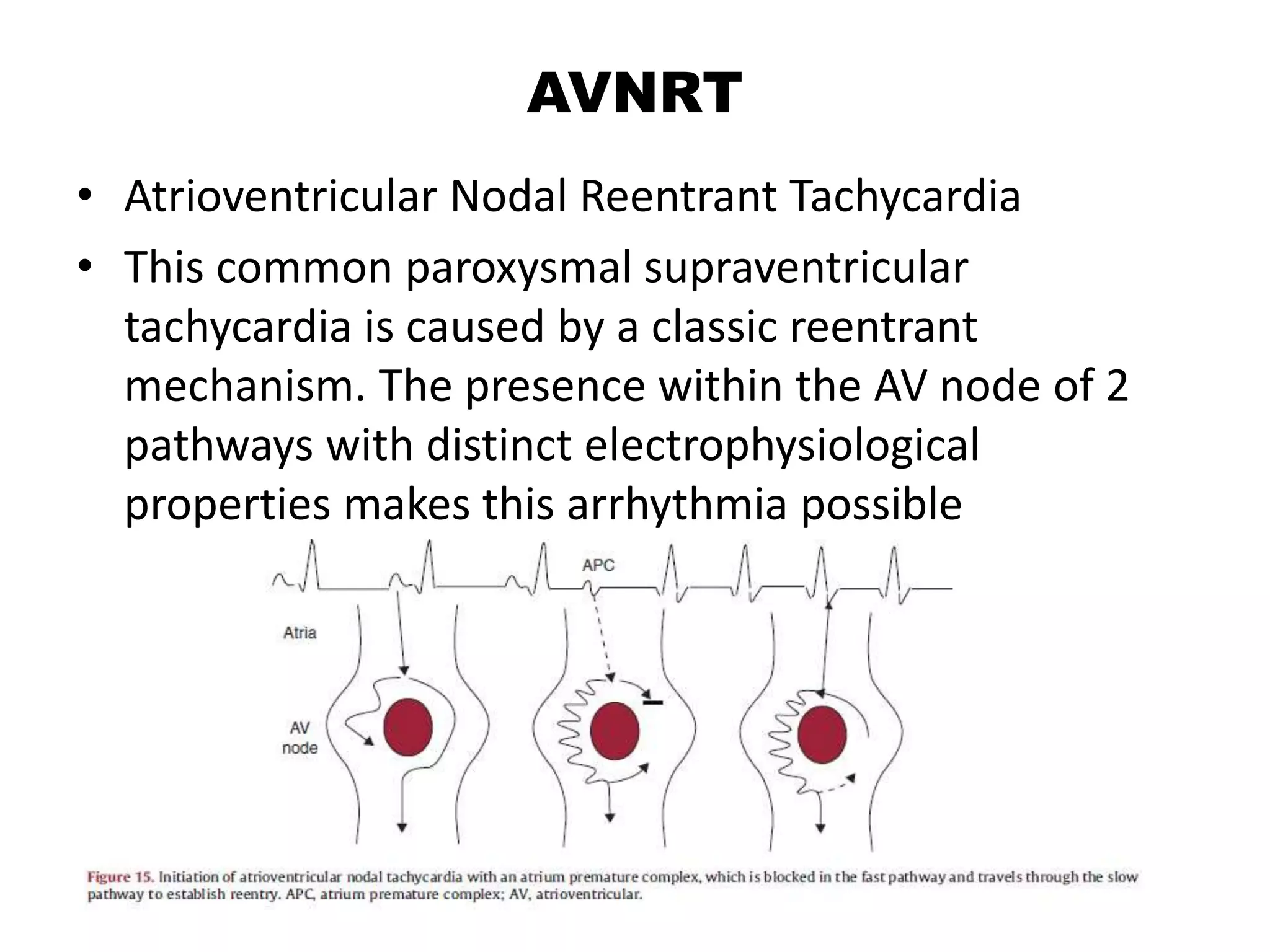 Mechanism of arrythmias | PPTX