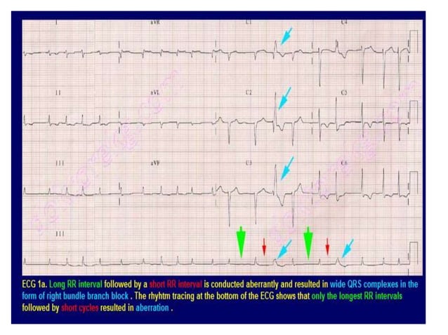 Mechanism of arrythmias | PPTX | Heart and Cardiovascular Diseases ...