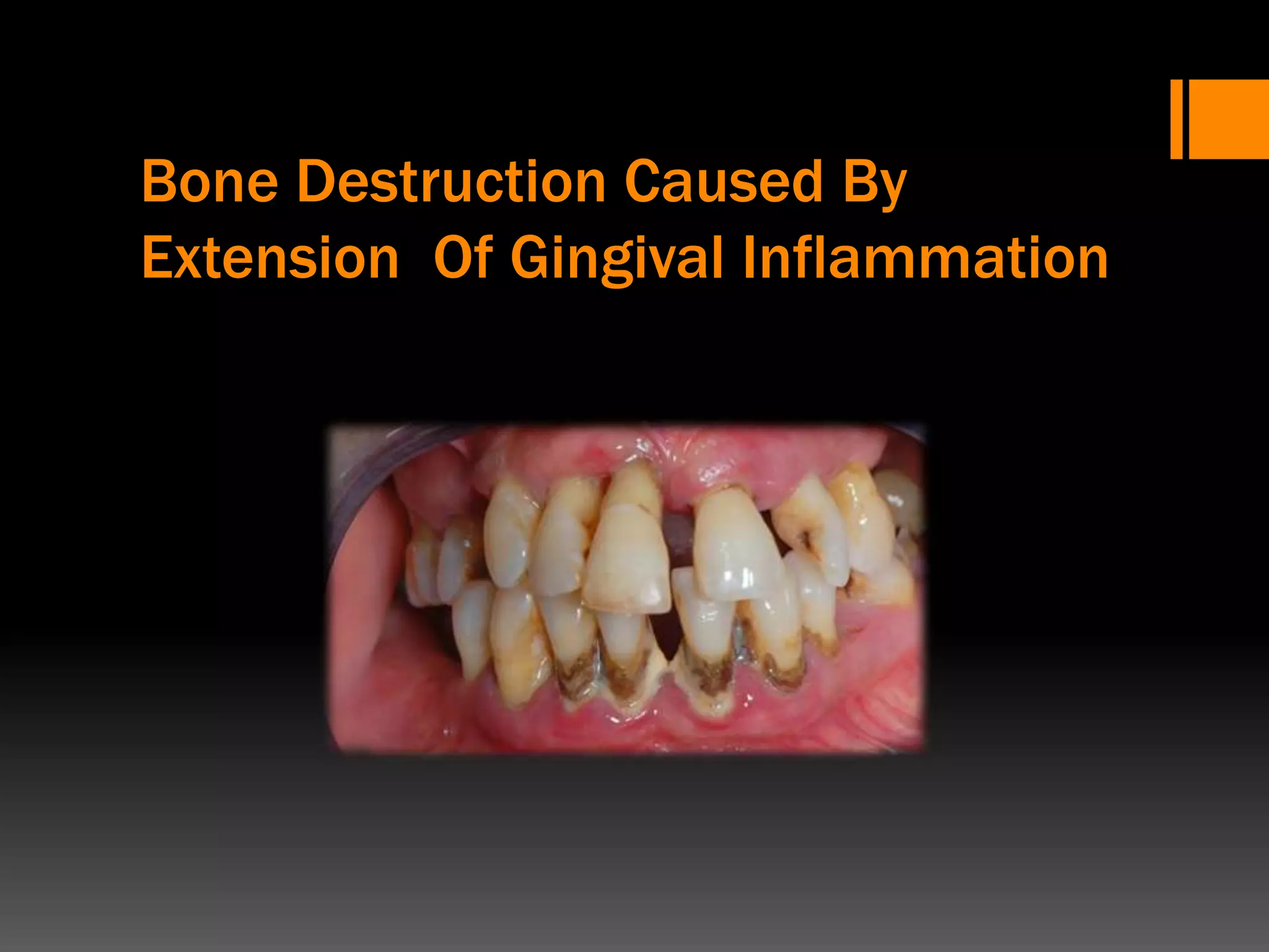 Mechanism of bone loss and patterns of bone loss | PPTX