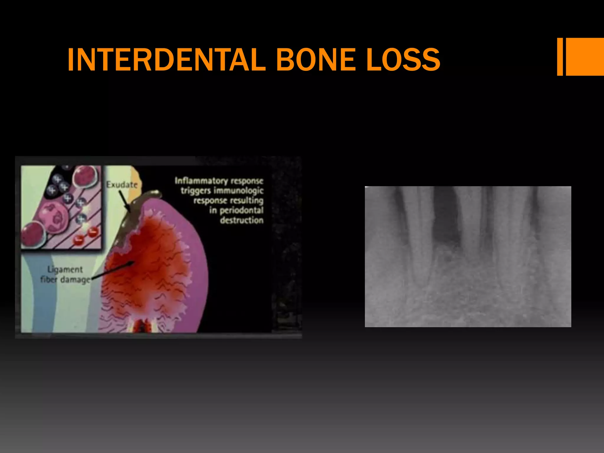 Mechanism of bone loss and patterns of bone loss | PPTX