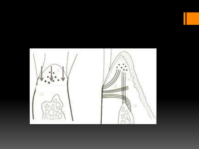 Mechanism of bone loss and patterns of bone loss | PPT