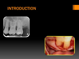 Mechanism of bone loss and patterns of bone loss | PPTX