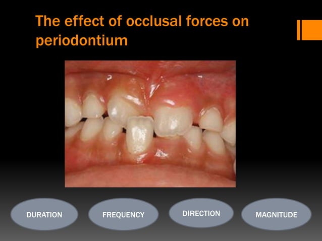 Mechanism of bone loss and patterns of bone loss | PPT