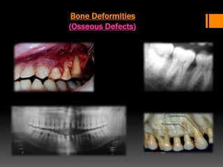 Mechanism of bone loss and patterns of bone loss | PPTX