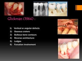 Mechanism of bone loss and patterns of bone loss | PPTX