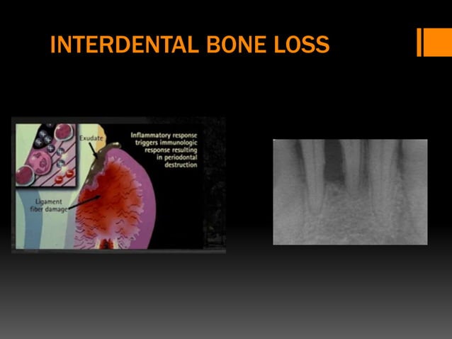 Mechanism of bone loss and patterns of bone loss | PPT
