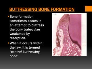 Buttressing Bone