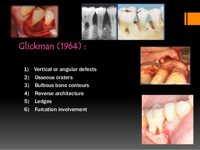 Mechanism of bone loss and patterns of bone loss