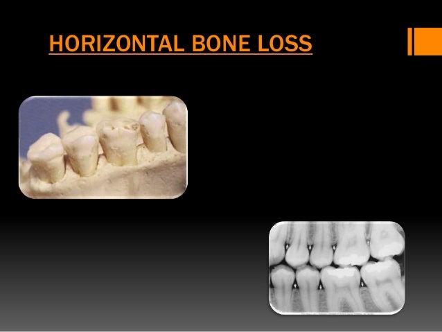 Mechanism of bone loss and patterns of bone loss