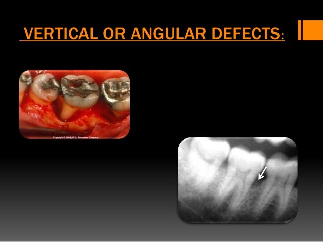 Mechanism of bone loss and patterns of bone loss