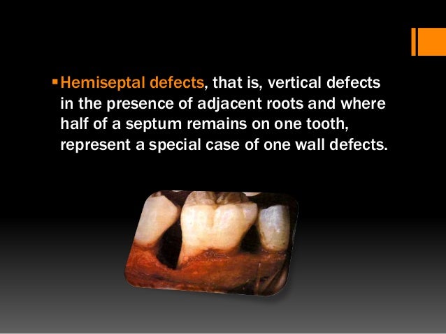 Mechanism of bone loss and patterns of bone loss