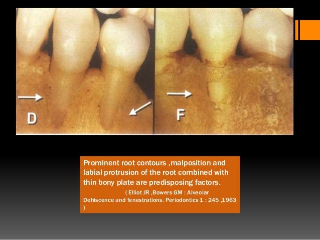 Mechanism of bone loss and patterns of bone loss