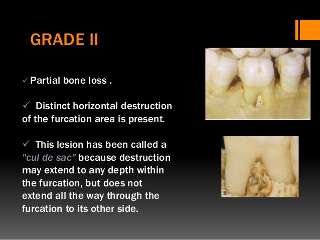 bone loss definition – osteoporosis definition – XDHN
