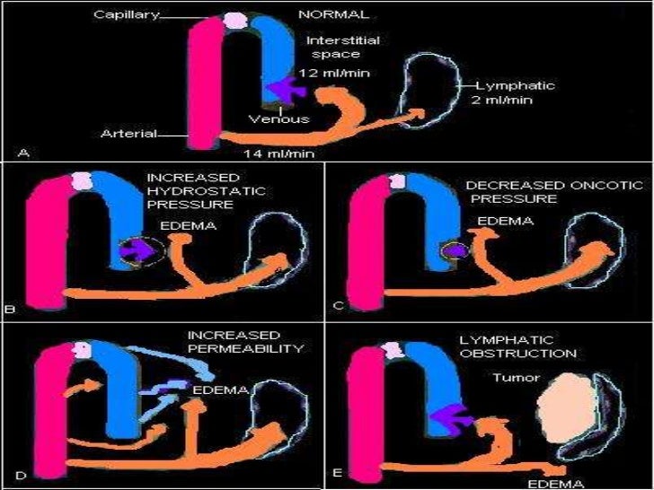 Mechanism of edema