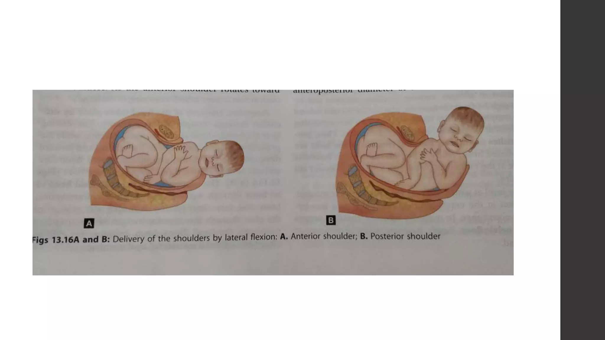 Mechanism of labor | PPTX