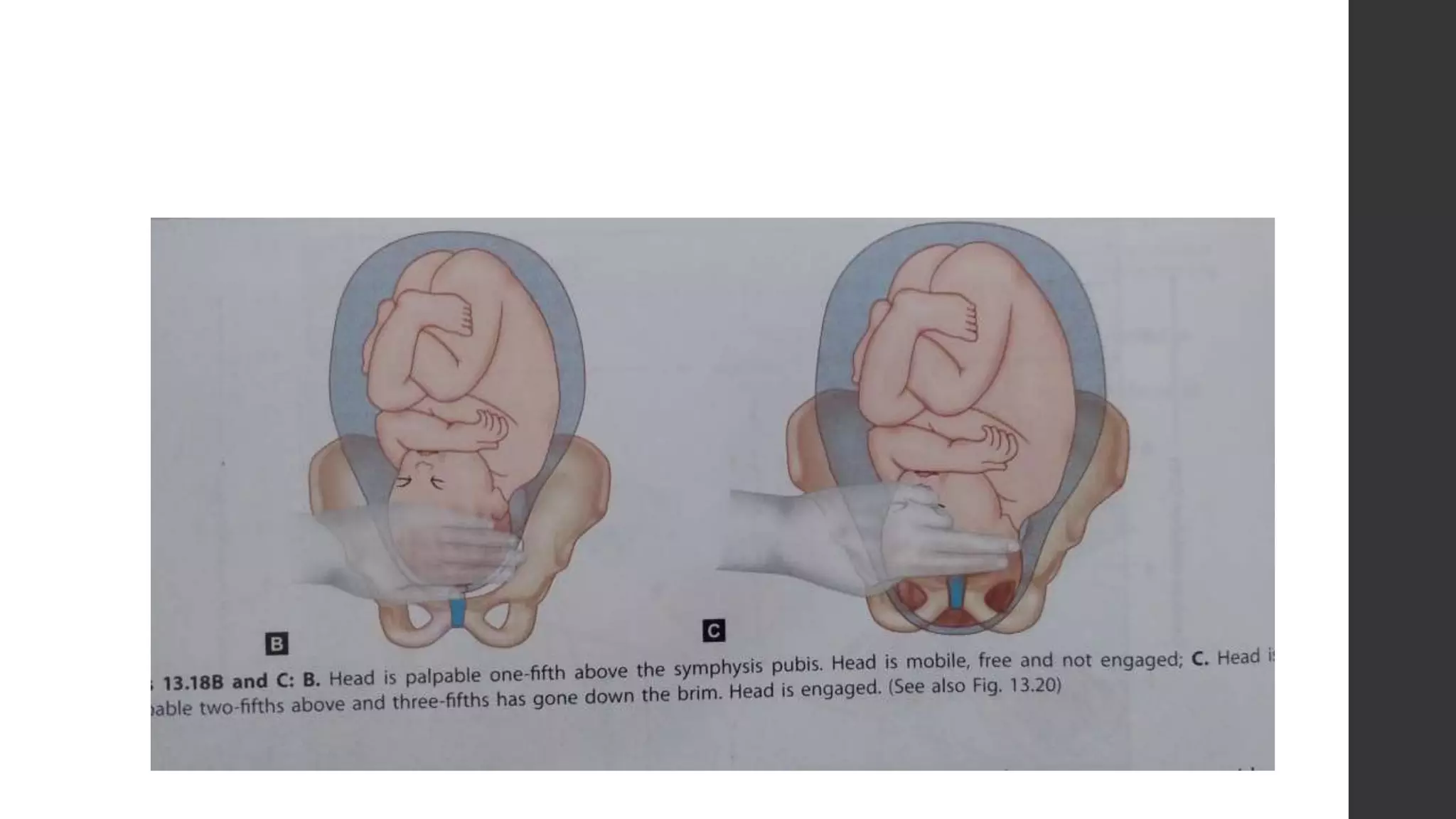 Mechanism of labor | PPT