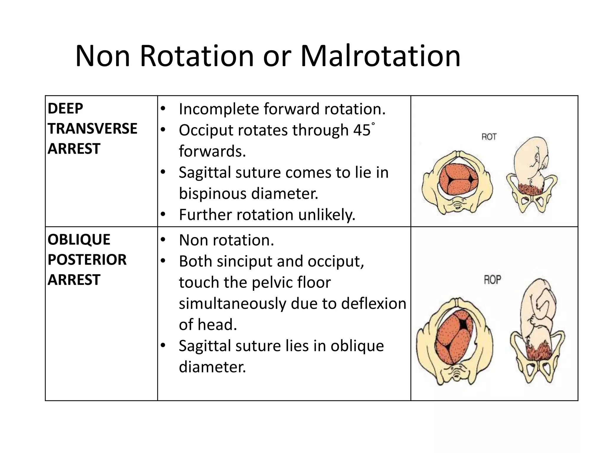 Mechanism of labor in right occipito posterior position | PPTX