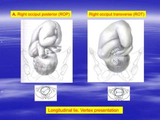 MECHANISM OF LABOUR (NORMAL and ABNORMAL).ppt