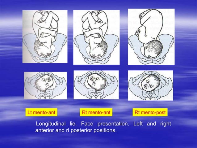 MECHANISM OF LABOUR (NORMAL and ABNORMAL).ppt | Pregnancy ...