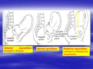 MECHANISM OF LABOUR (NORMAL and ABNORMAL).ppt
