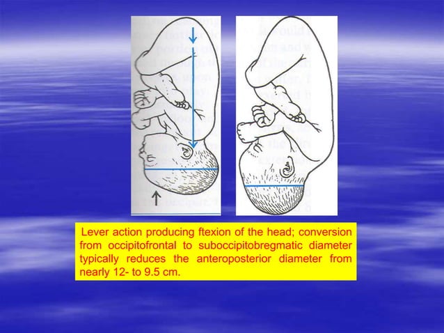 MECHANISM OF LABOUR (NORMAL and ABNORMAL).ppt | Pregnancy ...