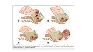 MECHANISM OF NORMAL LABOR in obs and gynaec | PPTX