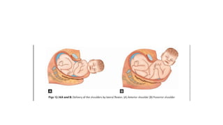 MECHANISM OF NORMAL LABOR in obs and gynaec | PPTX