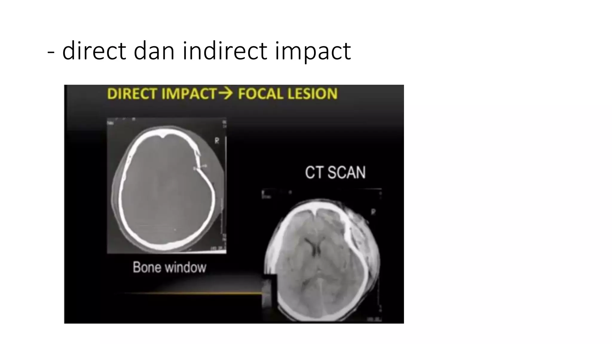 Mechanism of TBI.pptx