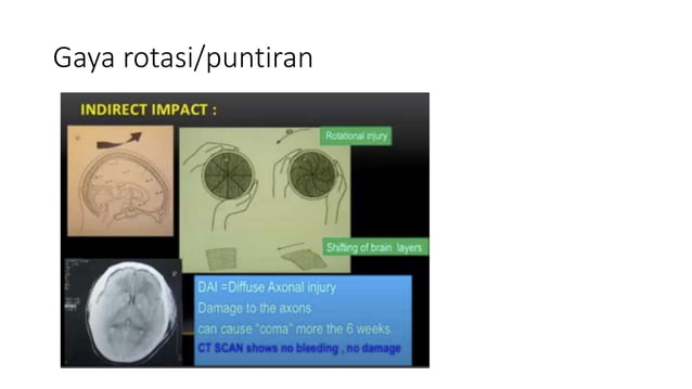 Mechanism of TBI.pptx