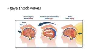 Mechanism of TBI.pptx