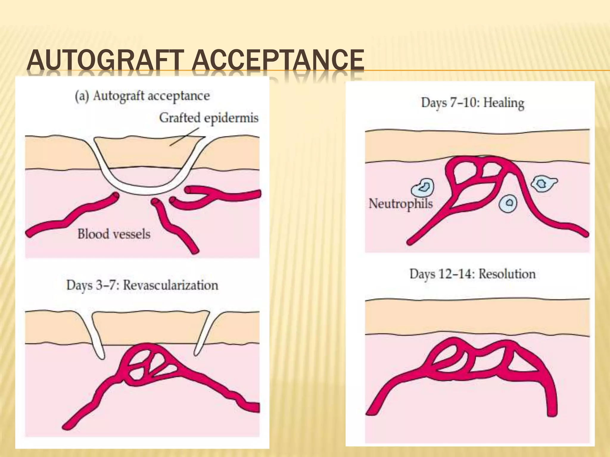 Mechanism of tissue graft rejection | PPTX
