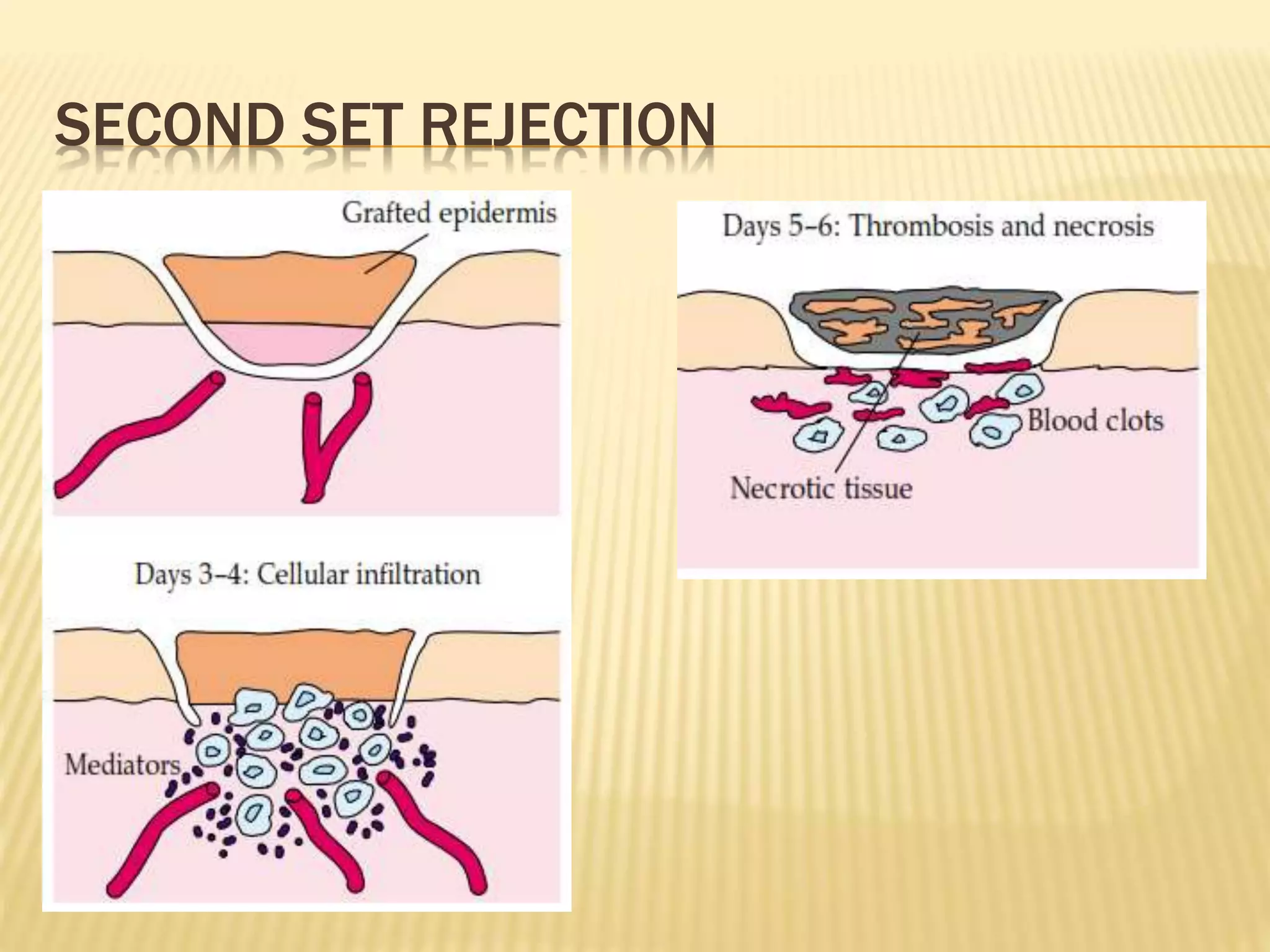 Mechanism of tissue graft rejection | PPTX