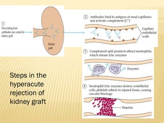 Mechanism of tissue graft rejection | PPTX