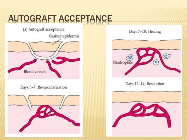 Mechanism of tissue graft rejection