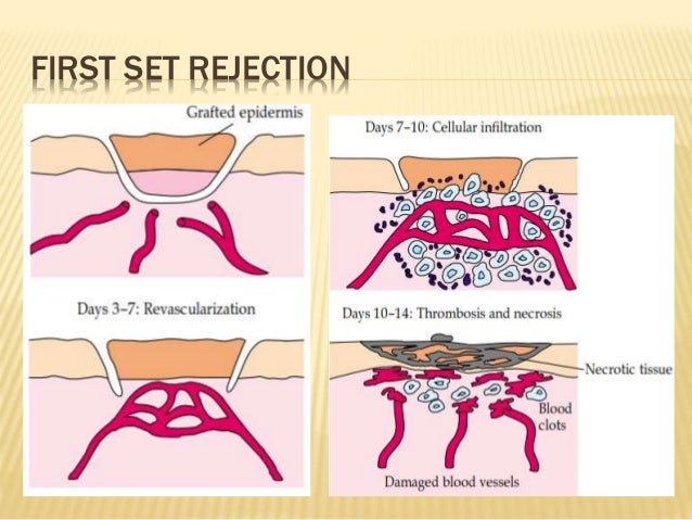 Mechanism of tissue graft rejection