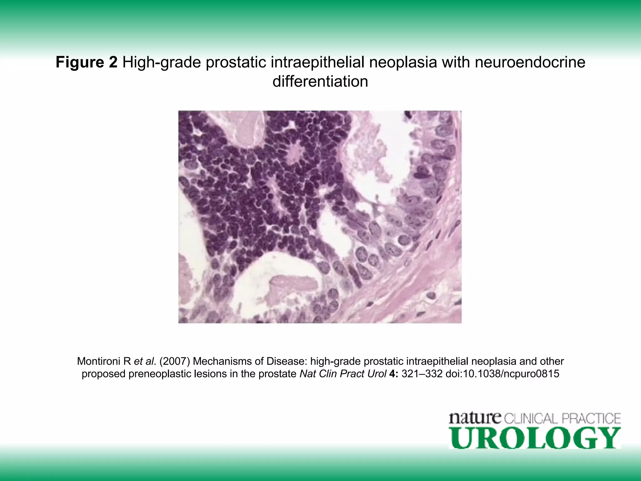 Mechanisms of Disease: high-grade prostatic intraepithelial neoplasia ...