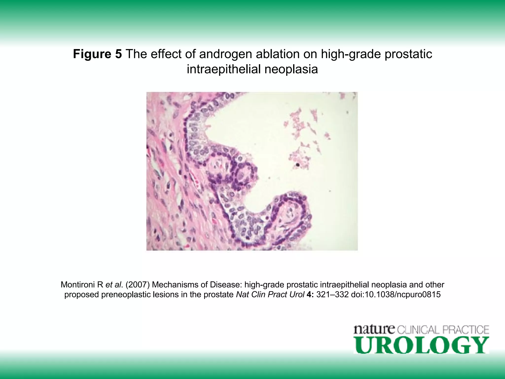 Mechanisms of Disease: high-grade prostatic intraepithelial neoplasia ...