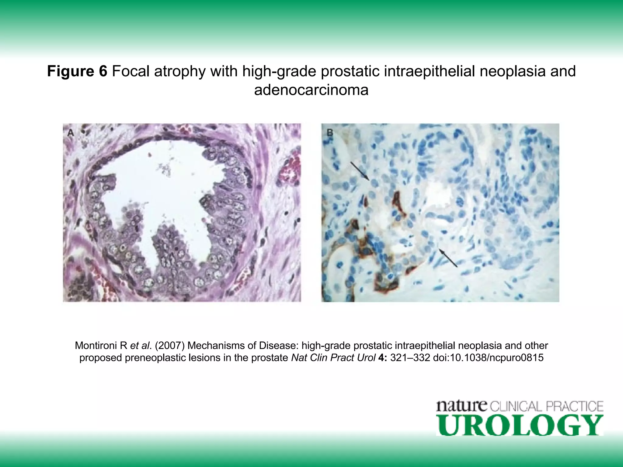 Mechanisms of Disease: high-grade prostatic intraepithelial neoplasia ...