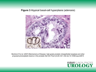 Mechanisms of Disease: high-grade prostatic intraepithelial neoplasia ...