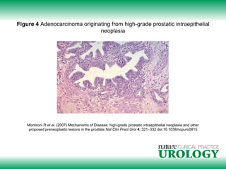 Mechanisms of Disease: high-grade prostatic intraepithelial neoplasia ...