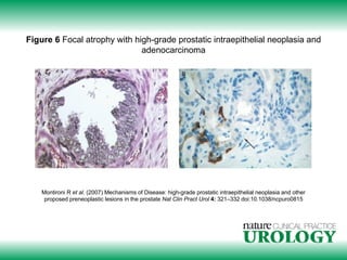 Mechanisms of Disease: high-grade prostatic intraepithelial neoplasia ...